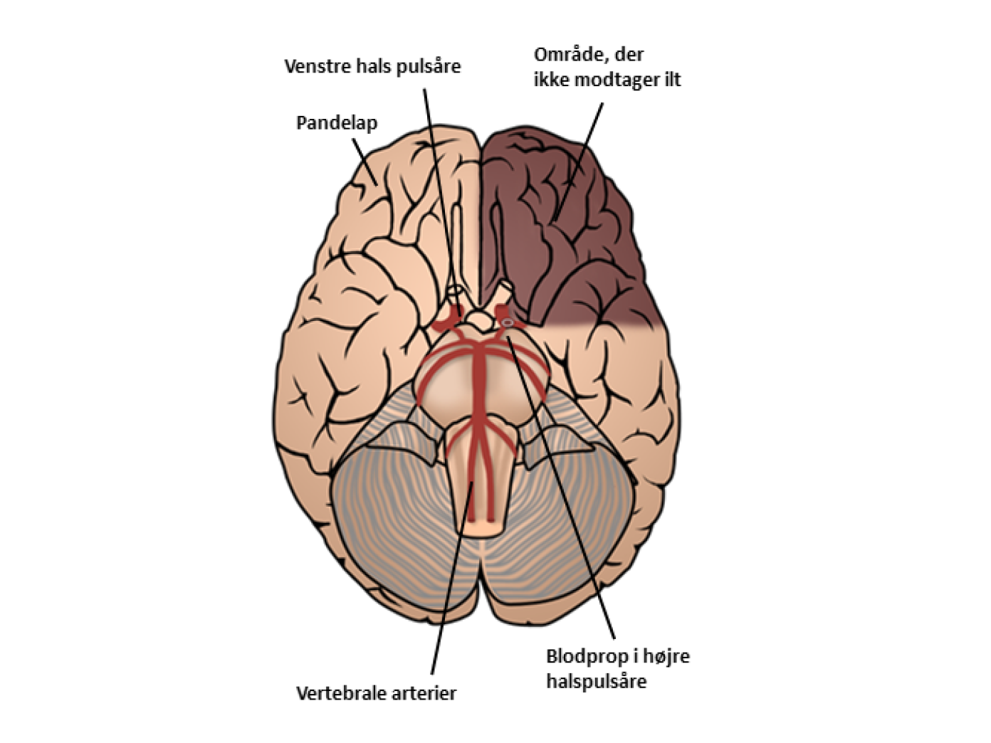 Infarkt | Neurorehabilitering – Kbh